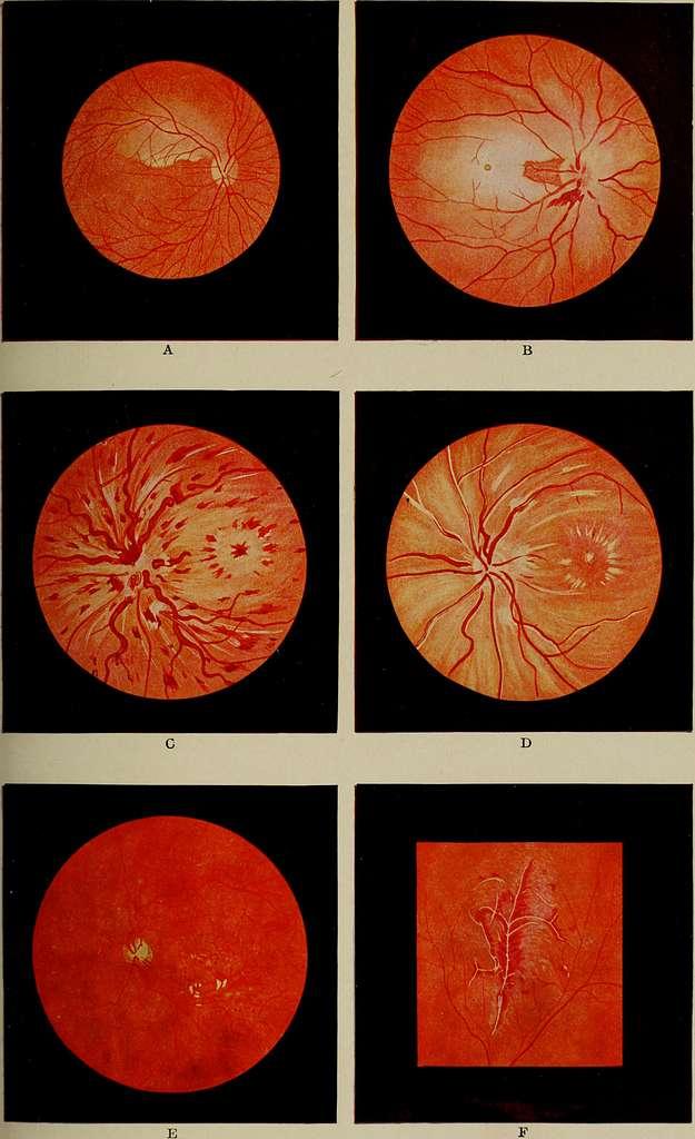 Countdown to Clear Vision: Pre-LASIK Contact Lens Timeline – Eye ...